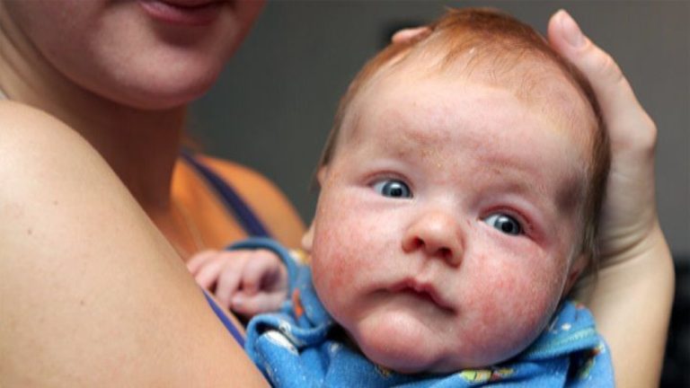 How To Treat Heat Rash In Babies? Types, Signs, & Treatment